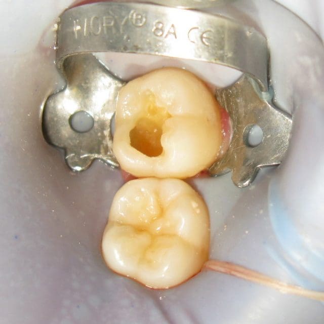 Clinical Cases | PDG Dental | Pediatric Dentistry & Orthodontics