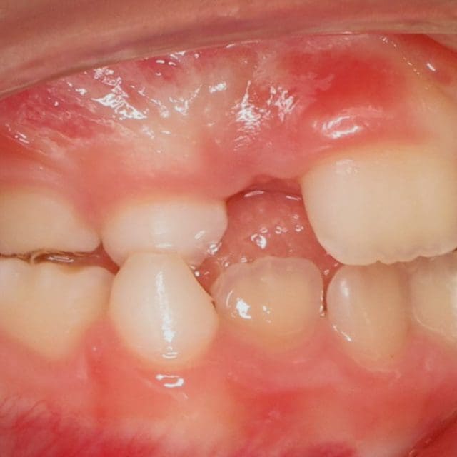 Early Treatment Gallery | PDG Dental | Pediatric Dentistry & Orthodontics