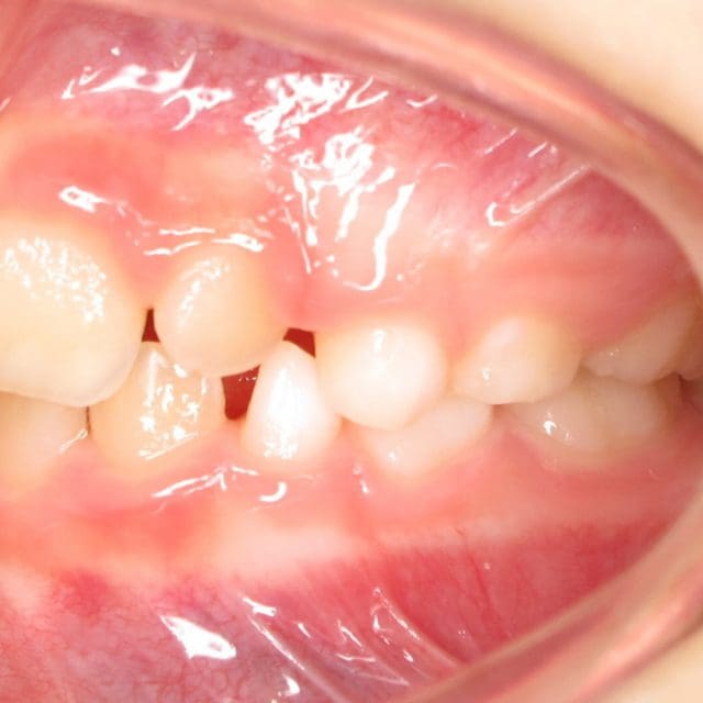 Early Treatment Gallery | PDG Dental | Pediatric Dentistry & Orthodontics