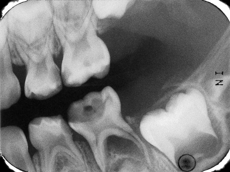 Clinical Cases - PDG Dental | Pediatric Dentistry & Orthodontics