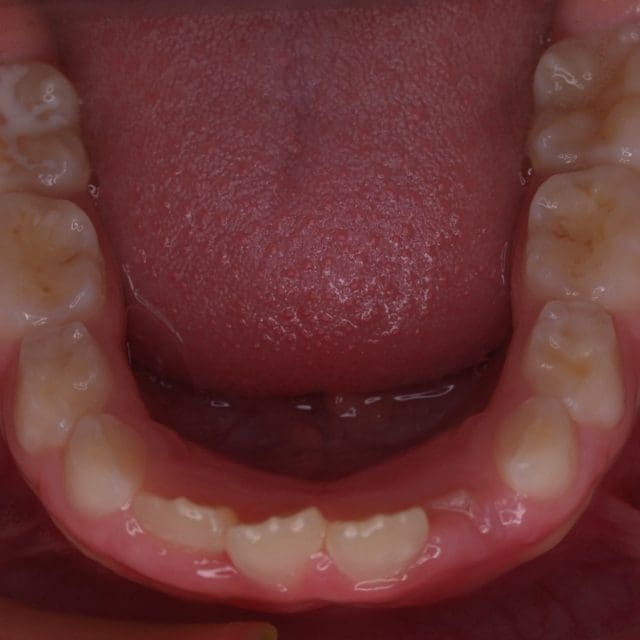 Early Treatment Gallery | PDG Dental | Pediatric Dentistry & Orthodontics