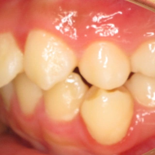 Full Treatment Gallery Pdg Dental Pediatric Dentistry And Orthodontics