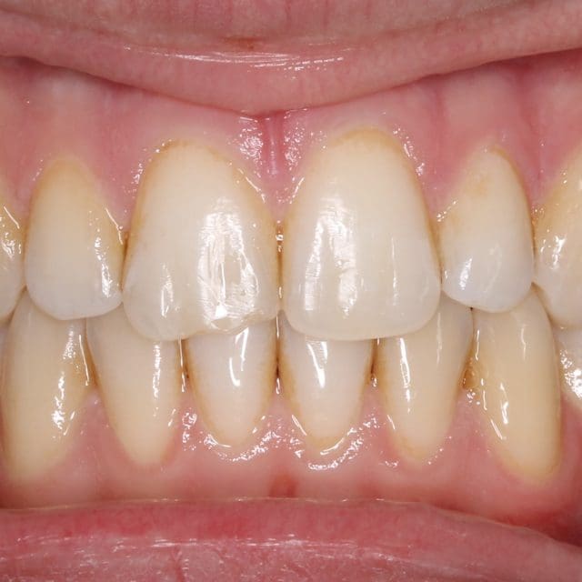 Full Treatment Gallery Pdg Dental Pediatric Dentistry And Orthodontics