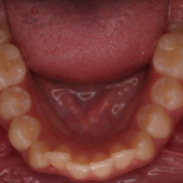 Full Treatment Gallery | PDG Dental | Pediatric Dentistry & Orthodontics