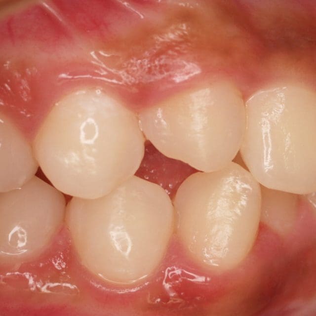 Full Treatment Gallery | PDG Dental | Pediatric Dentistry & Orthodontics