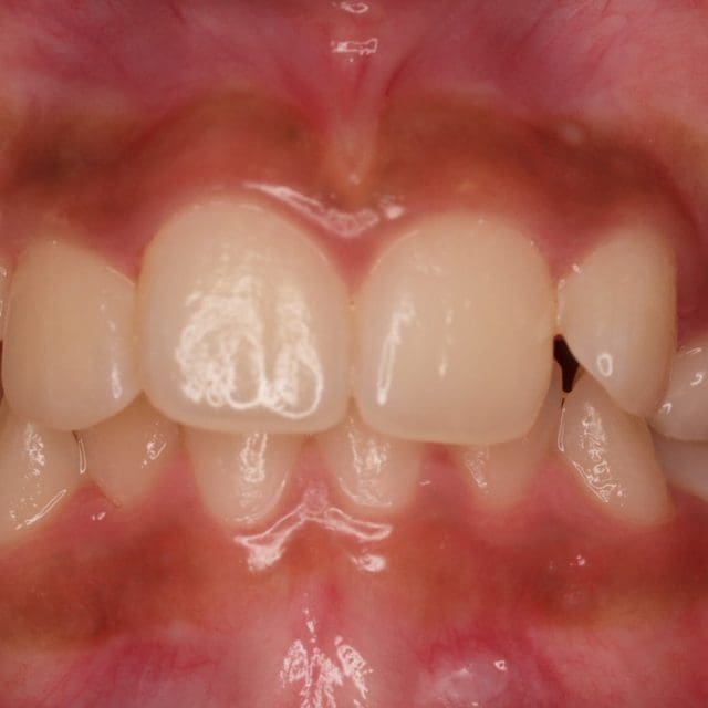 Full Treatment Gallery | PDG Dental | Pediatric Dentistry & Orthodontics