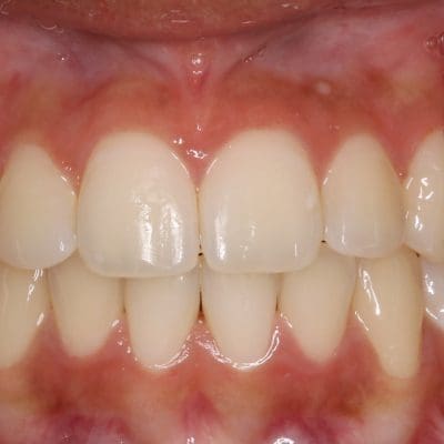 Full Treatment Gallery | PDG Dental | Pediatric Dentistry & Orthodontics